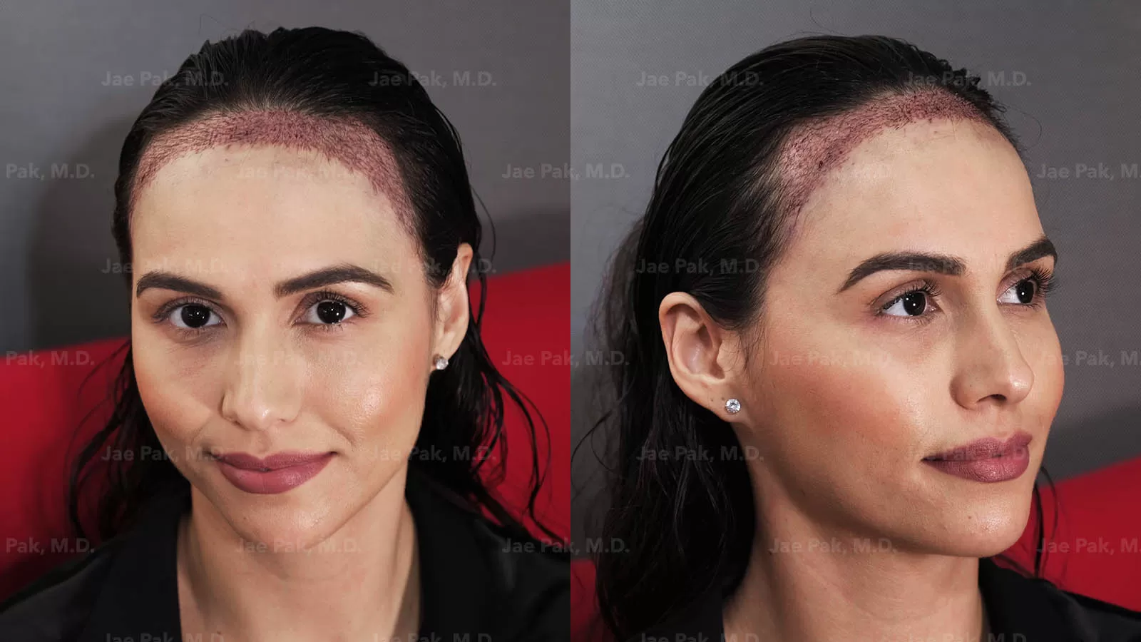 Hairline Lowering Surgery: How To Prepare for Your Visit