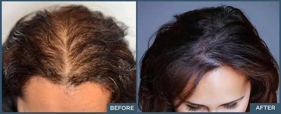 Female Patient Uses SMP To Create Thicker Hair | Jae Pak MD