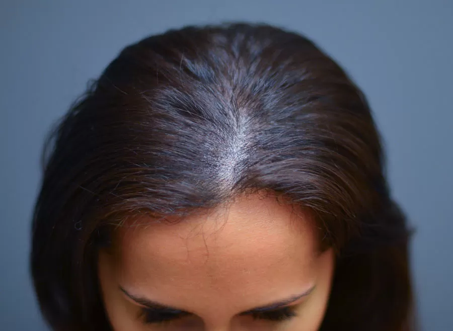 Female Patient Uses SMP To Create Thicker Hair | Jae Pak MD