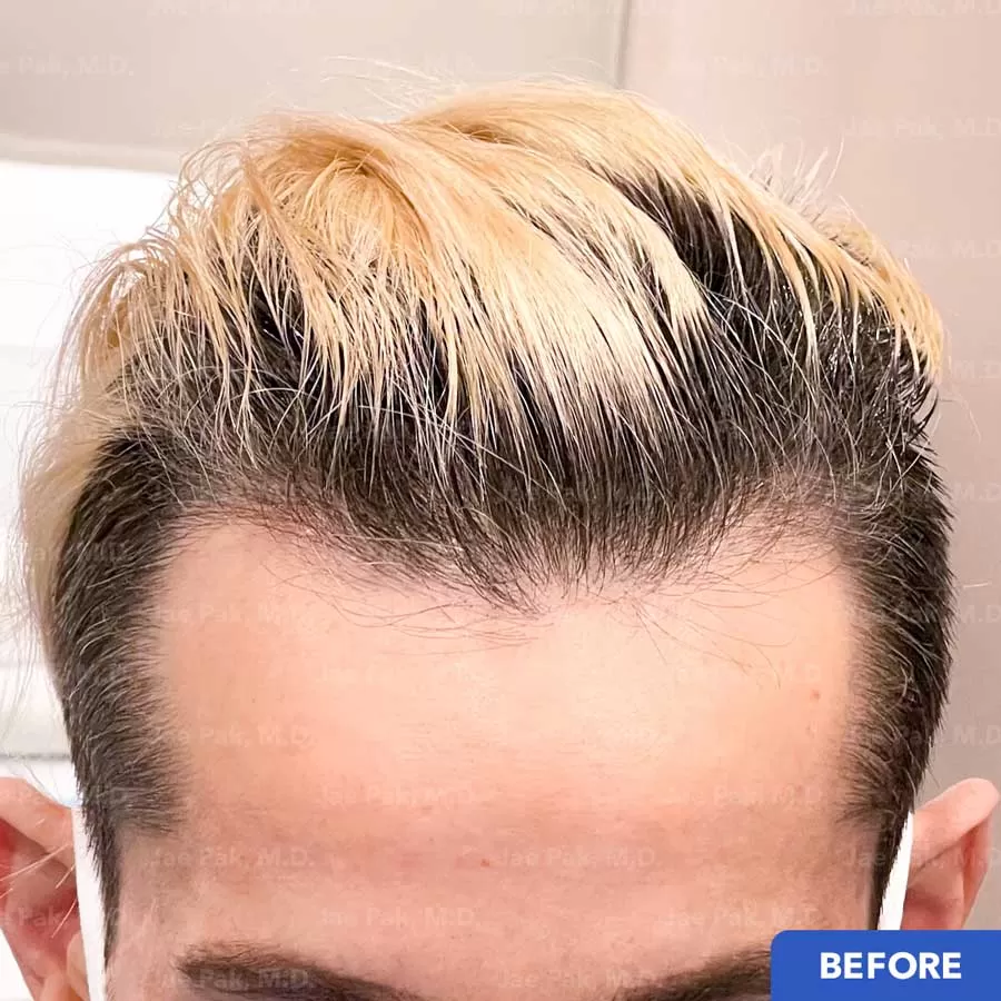 Entertainer Maintains His Youthful Hairline | Jae Pak MD