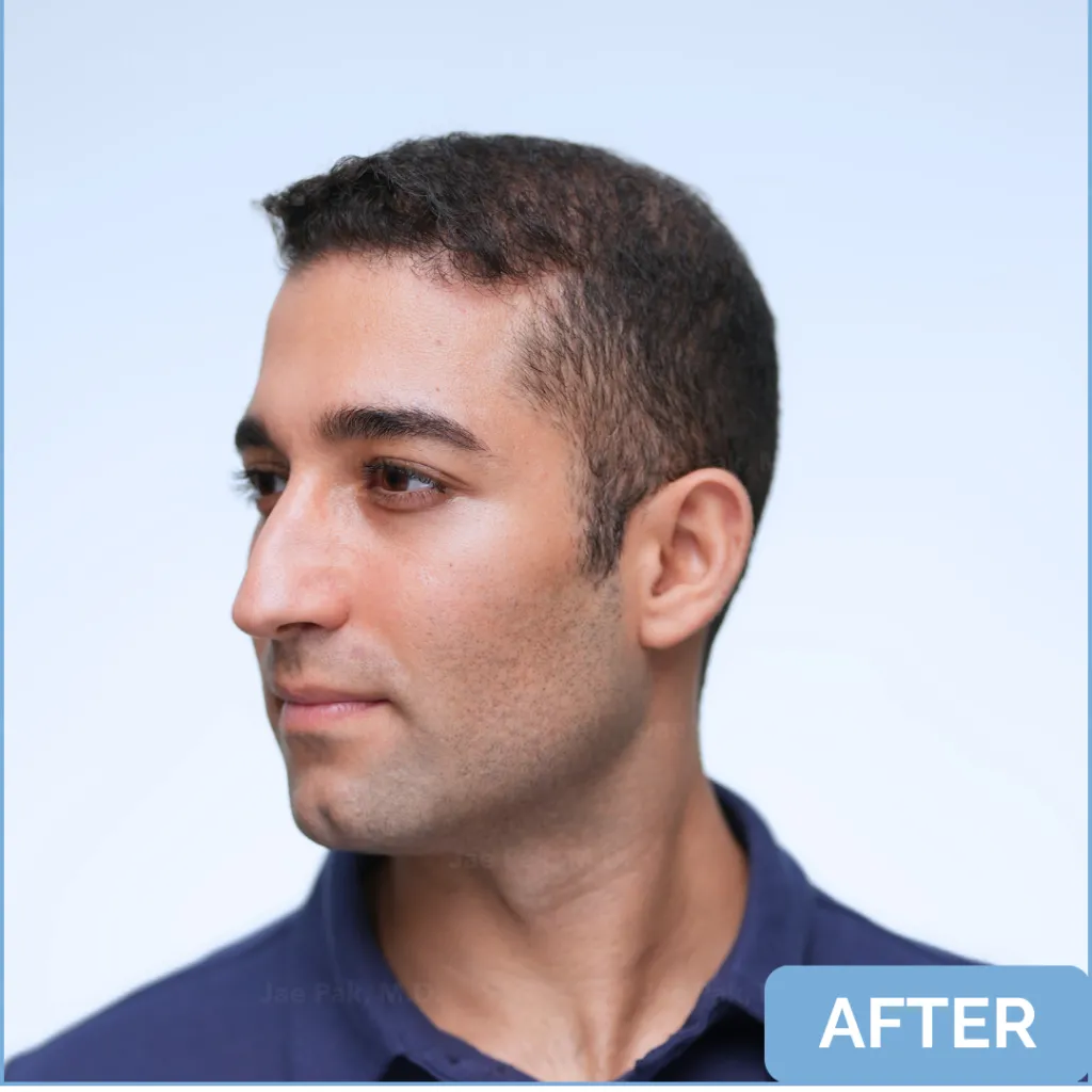 Brand New Hairline Thanks to Fue | Jae Pak MD