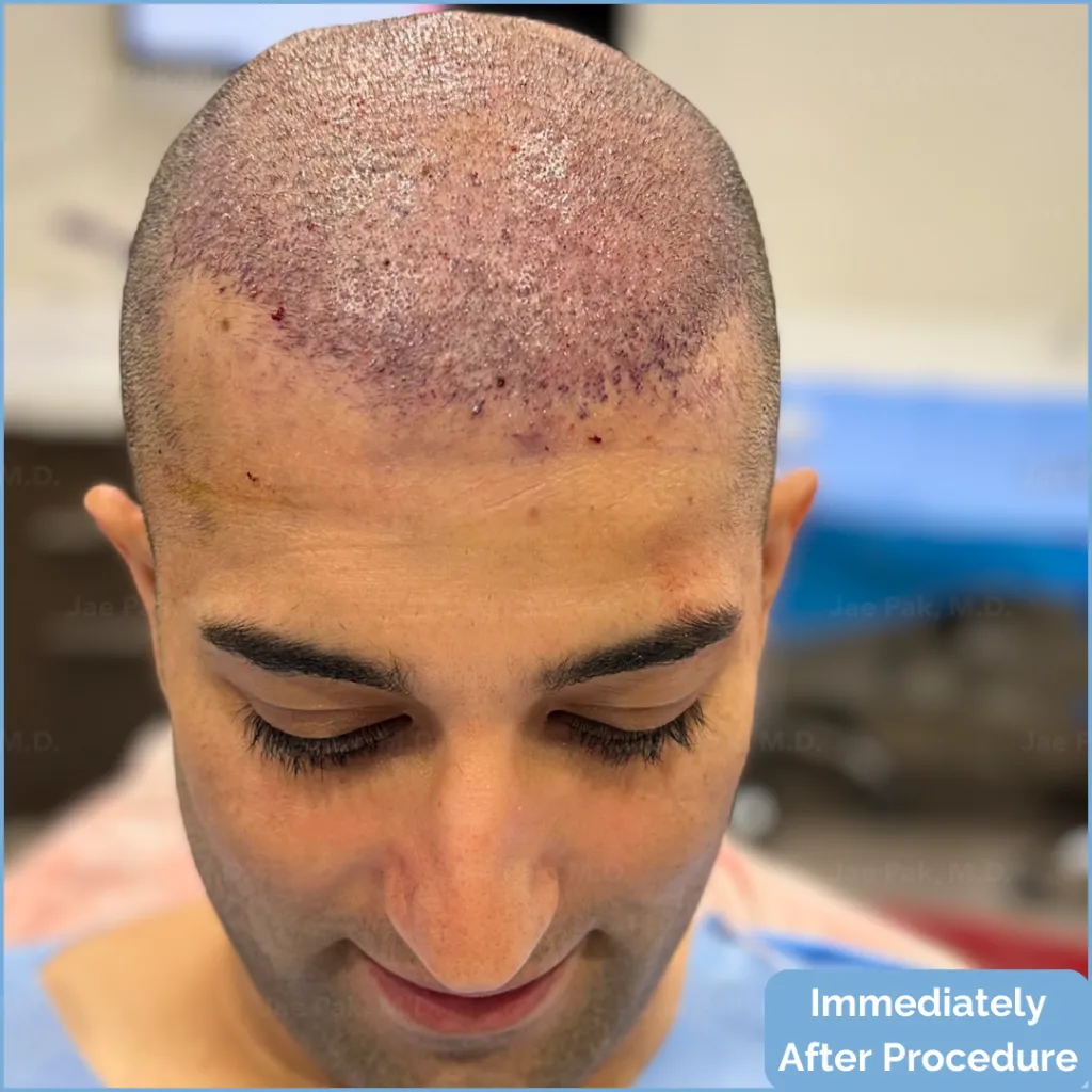 Brand New Hairline Thanks to Fue | Jae Pak MD