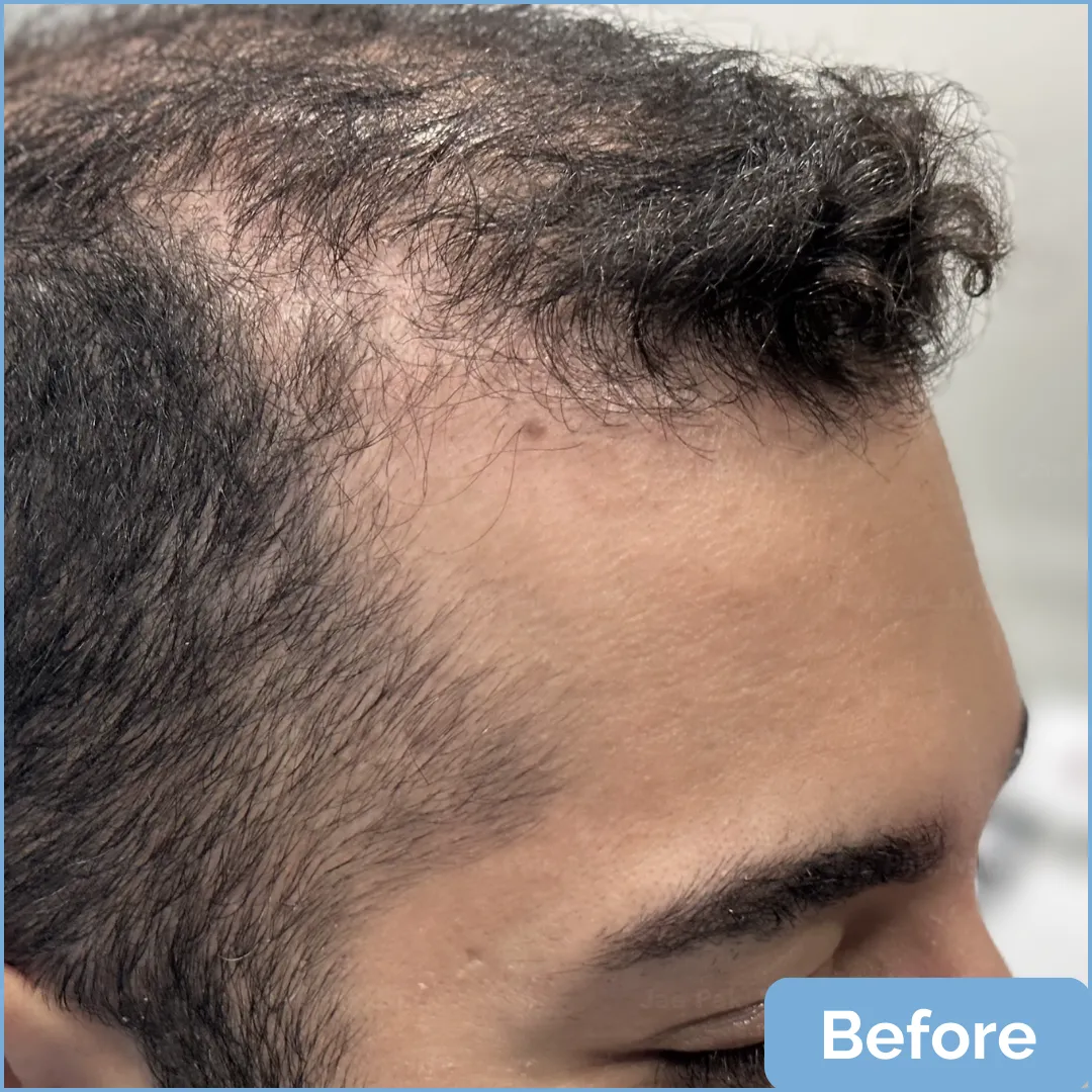 Brand New Hairline Thanks to Fue | Jae Pak MD