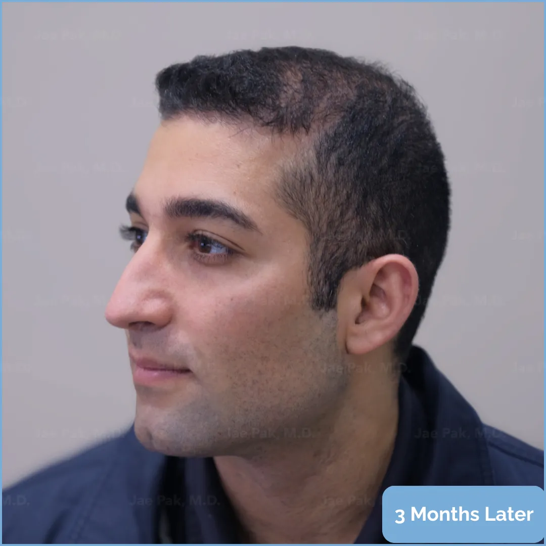 Brand New Hairline Thanks to Fue | Jae Pak MD