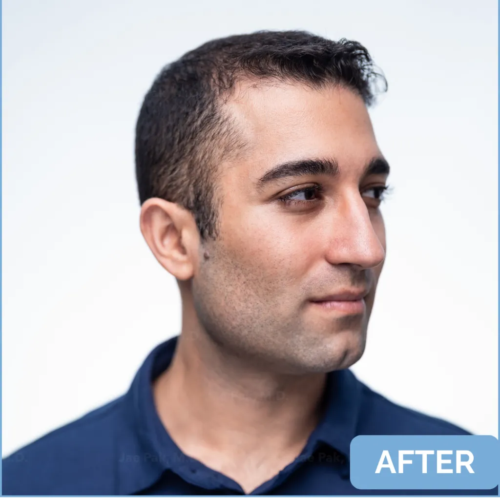 Brand New Hairline Thanks to Fue | Jae Pak MD
