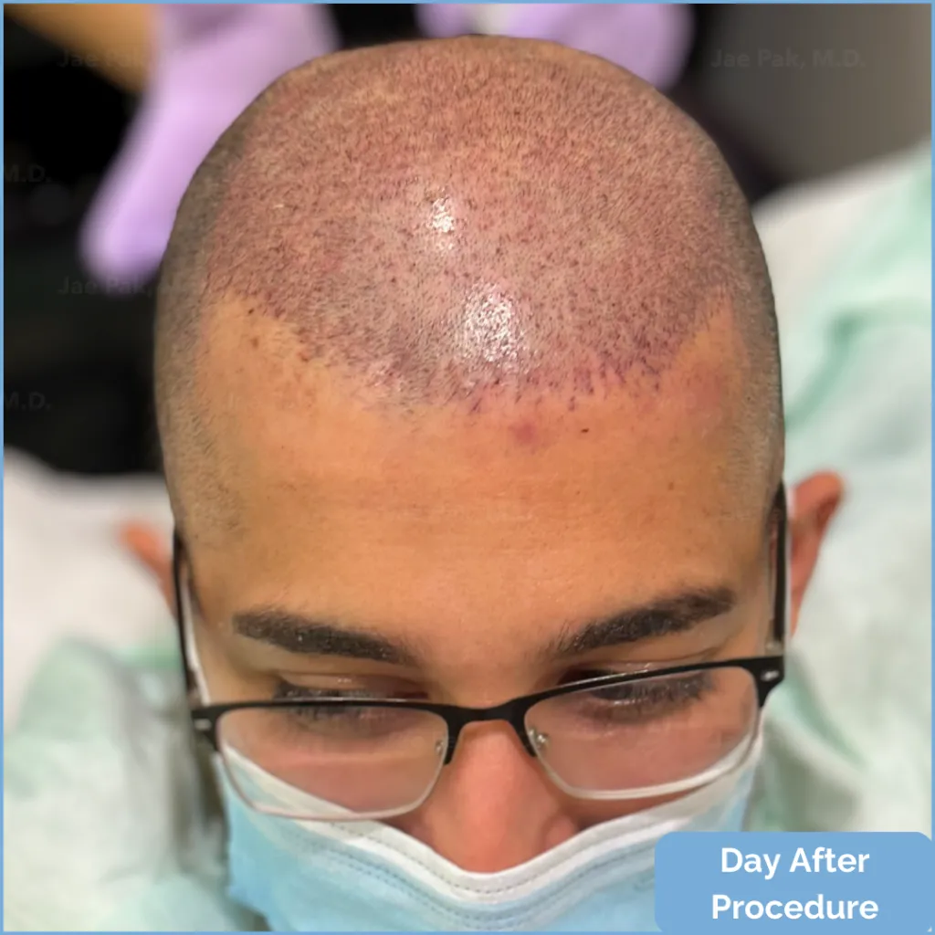 Brand New Hairline Thanks to Fue | Jae Pak MD