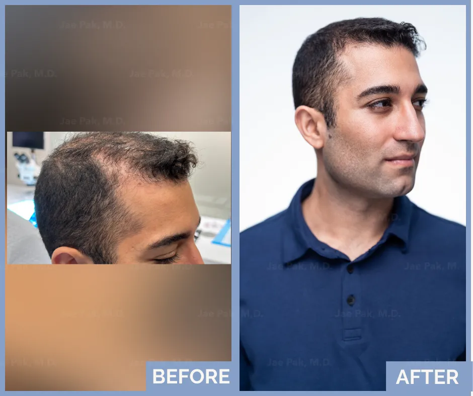 Brand New Hairline Thanks to Fue | Jae Pak MD